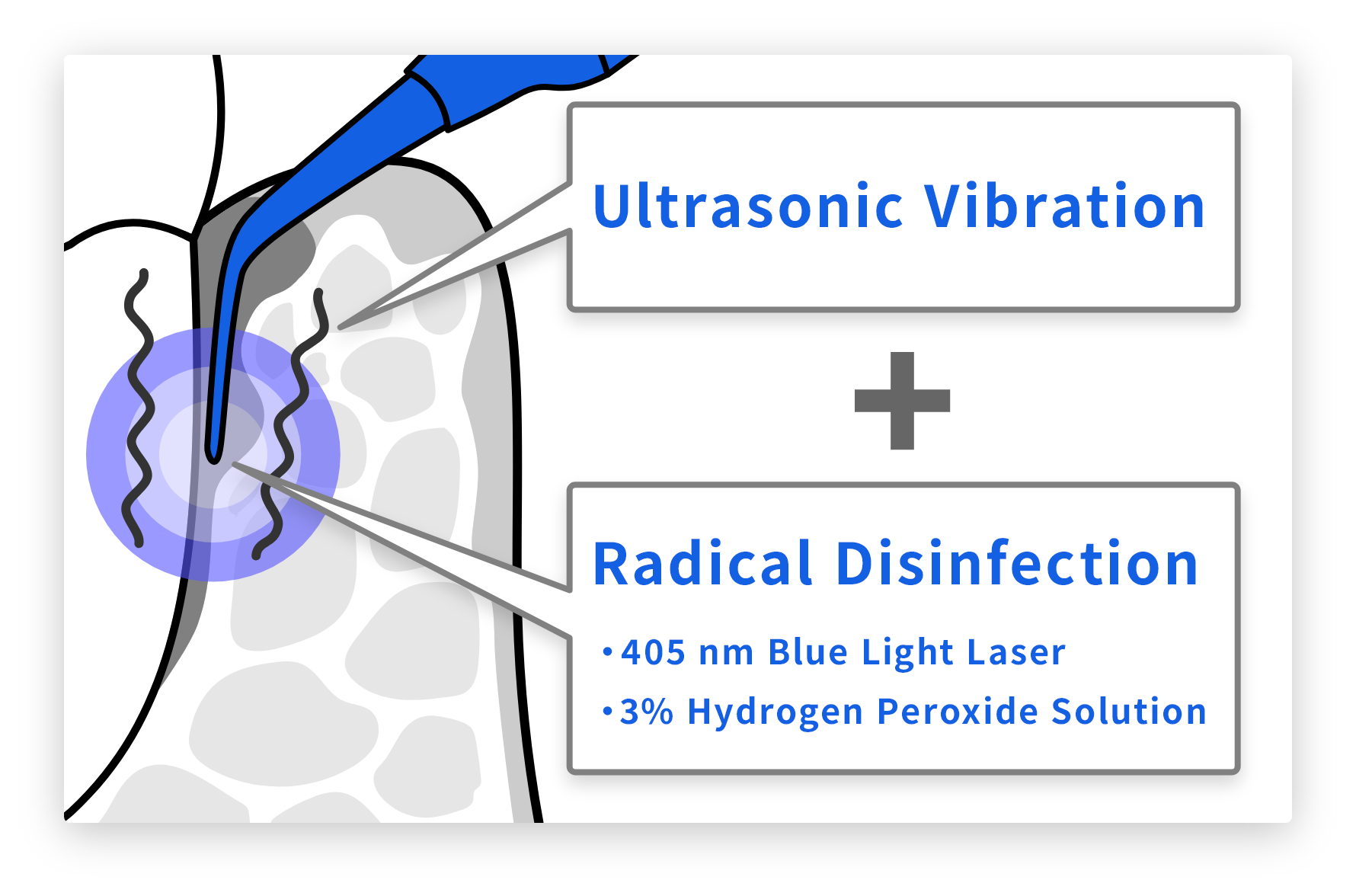Announcement: Introduction of the Periodontal Treatment Device “Blue ...